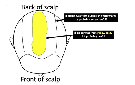 What Is More Accurate For Diagnosing Early Stages Of Hair Loss A