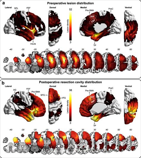 Lesion Overlap Maps Density Overlap Map Of A Preoperative Tumors And B