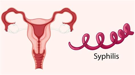 What Is Syphilis Infection Expert Explains Signs Symptoms And