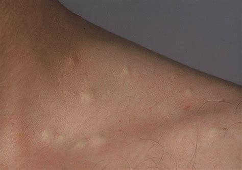 Surgical Pearl Mini Incisions For The Extraction Of Steatocystoma