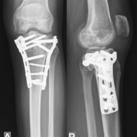 Arthroscopic Assisted Reduction And Internal Fixation Intraoperatively