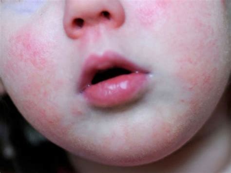 Scarlet Fever Rash Face