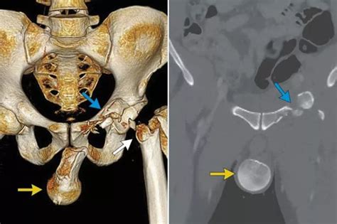 Motorcyclists Horrific Scrotum Injuries After Crash Are Guaranteed To