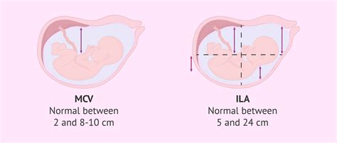 Methods For Measuring The Amount Of Amniotic Fluid