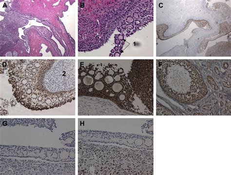 Non Peutz Jeghers Syndrome Associated Ovarian Sex Cord Tumor With