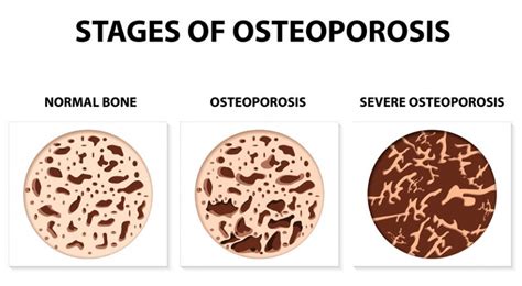 Osteoporosis Vs Osteopenia