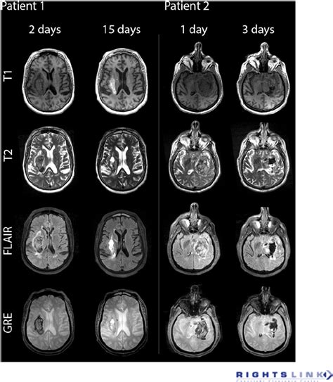 Mri Slices Acquired At Two Different Time Points Are Displayed For
