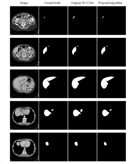 Schematic Representation Of The Liver 3d Segmentation Results