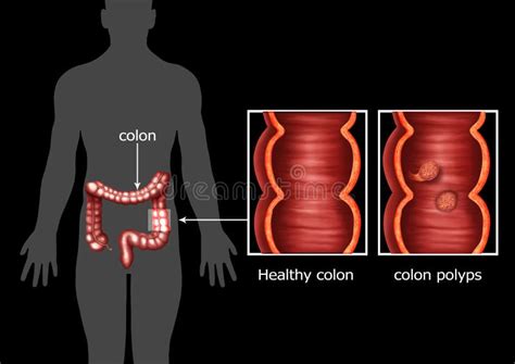 Colon Cancer Colon Polyps Stock Illustrations 125 Colon Cancer Colon