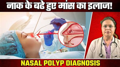 Nasal Polyps नाक के बढे हुए मांस का इलाज Nasal Polyp Diagnosis How