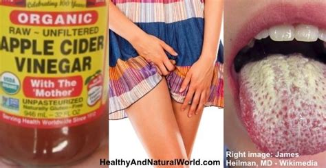 How To Effectively Use Apple Cider Vinegar For Yeast Infection