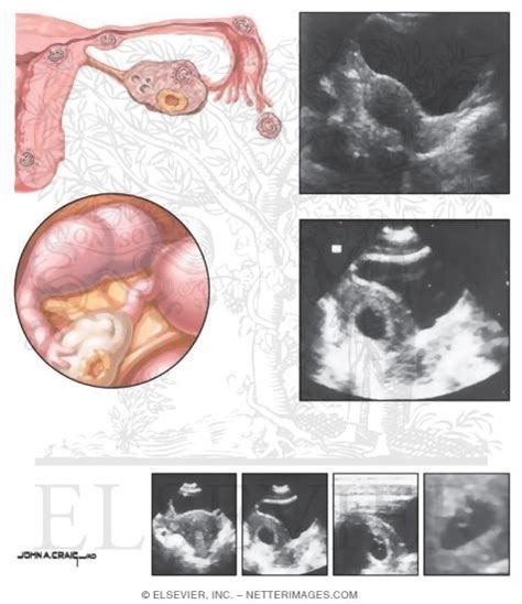 Diagnosis Of Ectopic Pregnancy