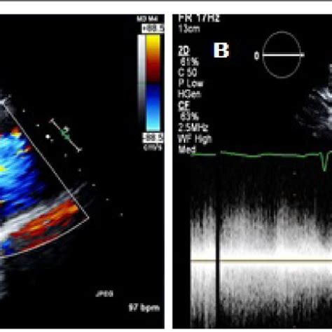 Two Dimensional Transthoracic Echocardiography In Parasternal Long Axis