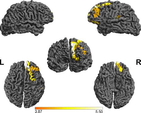 Frontiers Brain Cortical Complexity And Subcortical Morphometrics In