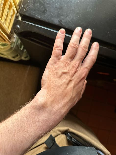 Does Anybody Know Whats Up With This Orange Discoloration On My Hand