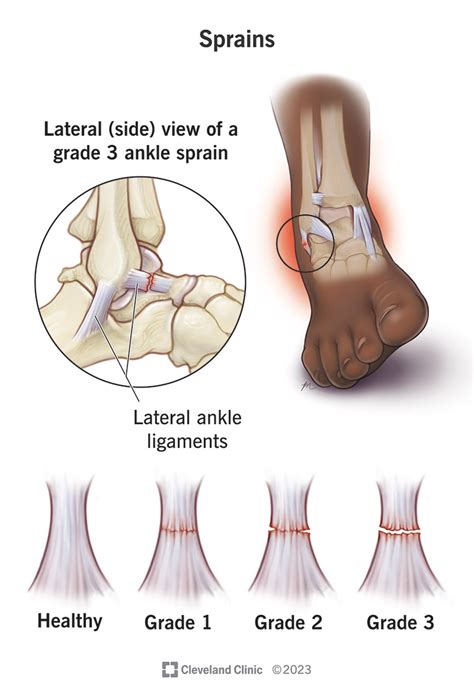 Ankle Sprain Grades 1