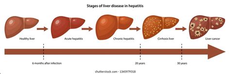 Liver Cirrhosis Stages