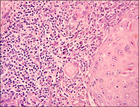 Clinico Pathological Prognosticators In Oral Squamous Cell Carcinoma