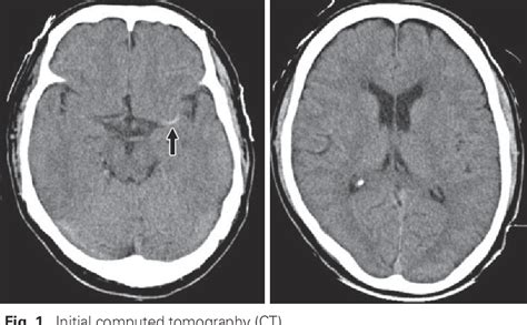Figure 1 From A Case Of Internal Carotid Artery Occlusion And Middle