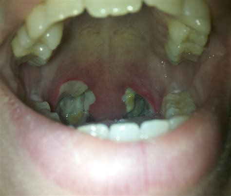 Tonsillectomy Day 6 Scabs Bleeding Tonsillectomy Planning And Recovery