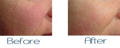 Tips For Treating Large Pores Cosmetic Dermatology Manhattan Beach