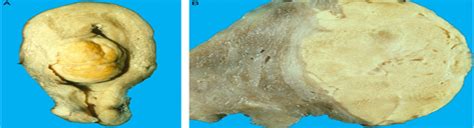 Uterine Tumors Resembling Ovarian Sex Cord Tumors A Clinico The