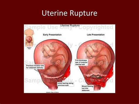 Ppt Obstetric Hemorrhage Powerpoint Presentation Free Download Id