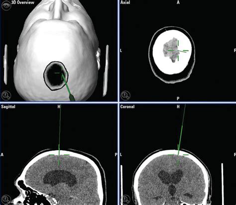 Endoscopic Third Ventriculostomy Intechopen
