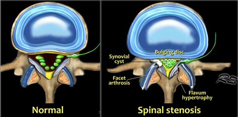 The Radiology Assistant Spine Lumbar Disc Herniation