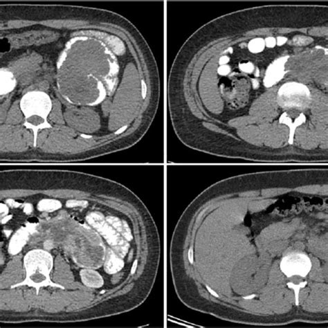 Enhanced Abdominal Computed Tomography Download Scientific Diagram