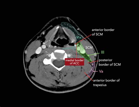 Cervical Lymph Nodes Radiology