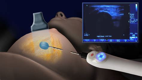 National Multi Center Clinical Trial Of Non Surgical Breast Cancer