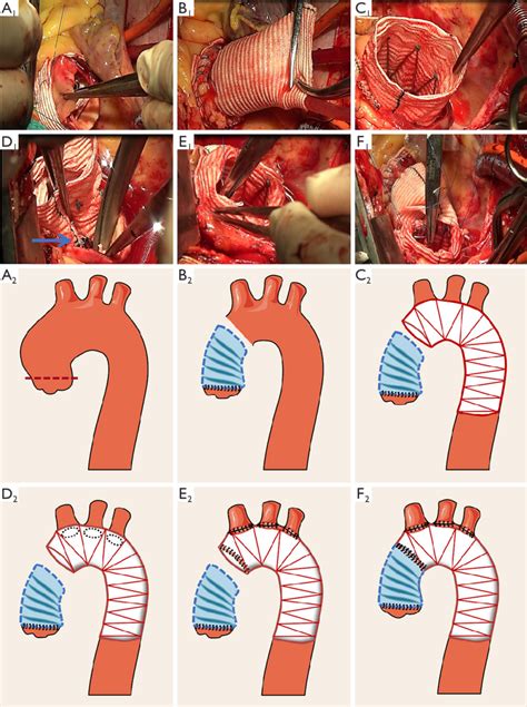 Procedure Of The Ascending Aorta Replacement And Aortic Arch