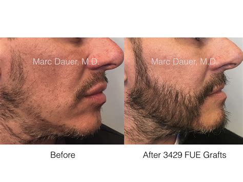 Beard Transplant Before And After Pictures