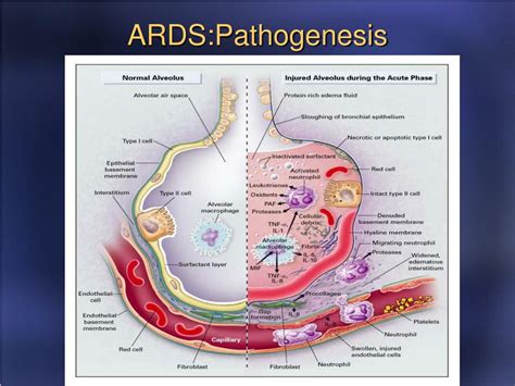 Ppt Ards Powerpoint Presentation Free Download Id 3928837