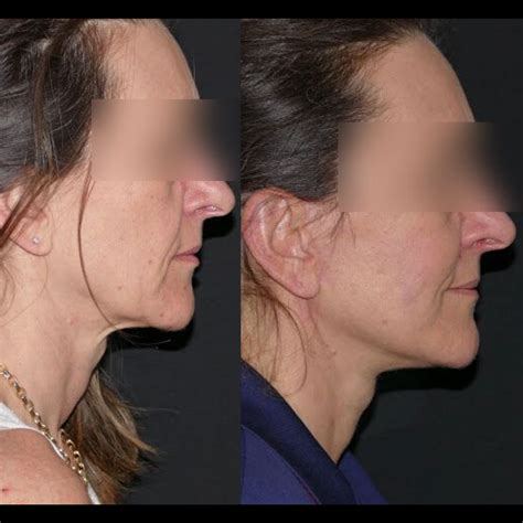 Lifting Du Visage Et Du Cou Chirurgie Esthétique Paris — Dr Gérald Franchi