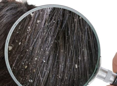 Different Types Of Dandruff And How To Stop Them Vlr Eng Br