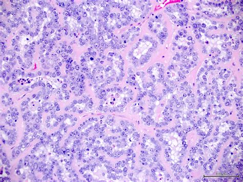Pathology Outlines Clear Cell Carcinoma