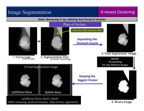 Microcalcification Identification In Digital Mammogram For Early