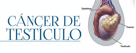 Cancer De Testiculo Sintomas