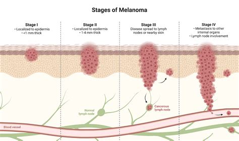 Melanoma Staging Biorender Science Templates