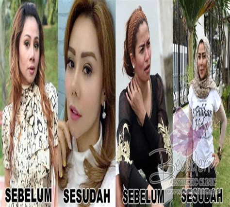Cantikan Mana Perubahan Pada 6 Artis Sebelum Dan Sesudah Di Filler