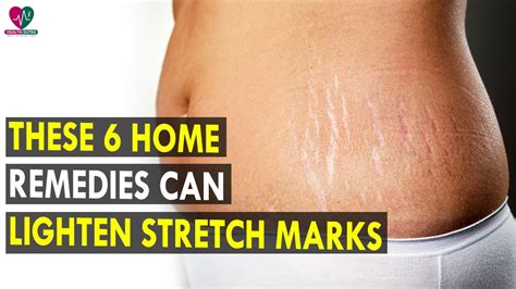 These 6 Home Remedies Can Lighten Stretch Marks Health Sutra Best