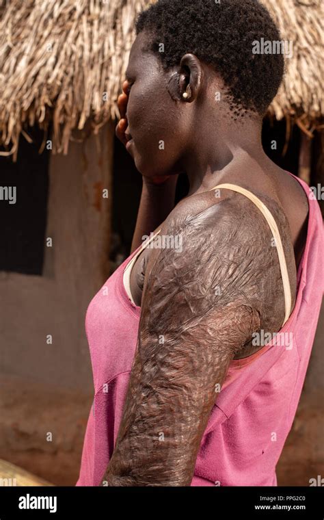 African Woman Burn Victim Covers Her Face While Showing Scars On Her