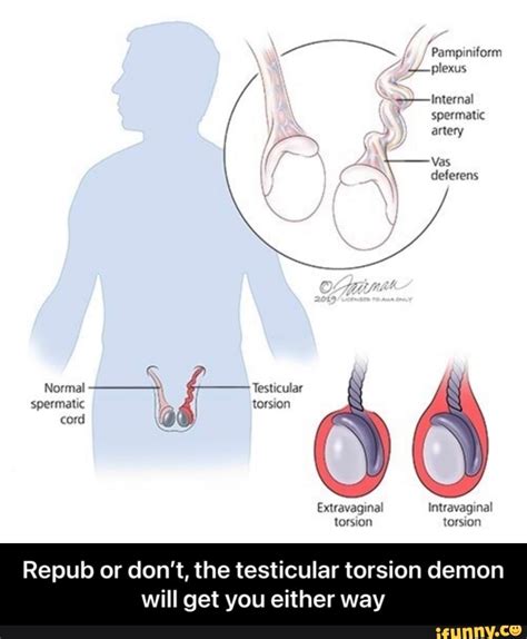 2lplexus Internal Spermatic Artery Deferens Normal Testicular Spermatic