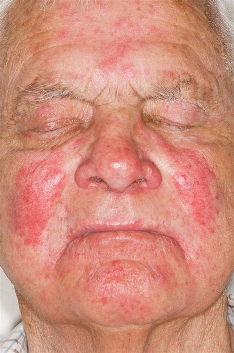 Allergic Skin Reaction To A Drug Photograph By Dr P Marazzi Science