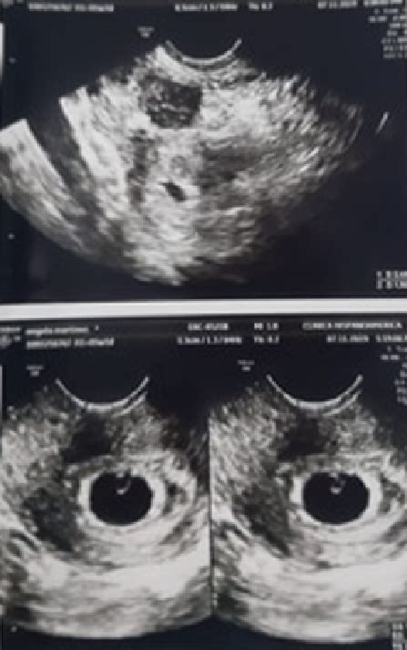 Transvaginal Ultrasound With Visualization Of Intrauterine Pregnancy
