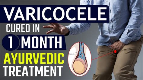 100 Ayurvedic Treatment For Varicocele वैरीकोसेल ठीक करें बिना