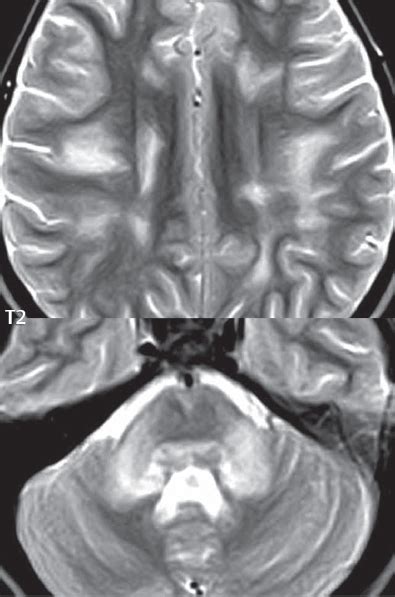 Demyelinating Disease Radiology Key