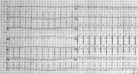 ecg ekg examples and quiz oxford medical education